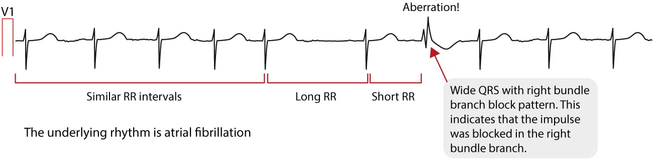 Vorhofflimmern: EKG, Klassifikation, Ursachen, Risikofaktoren ...