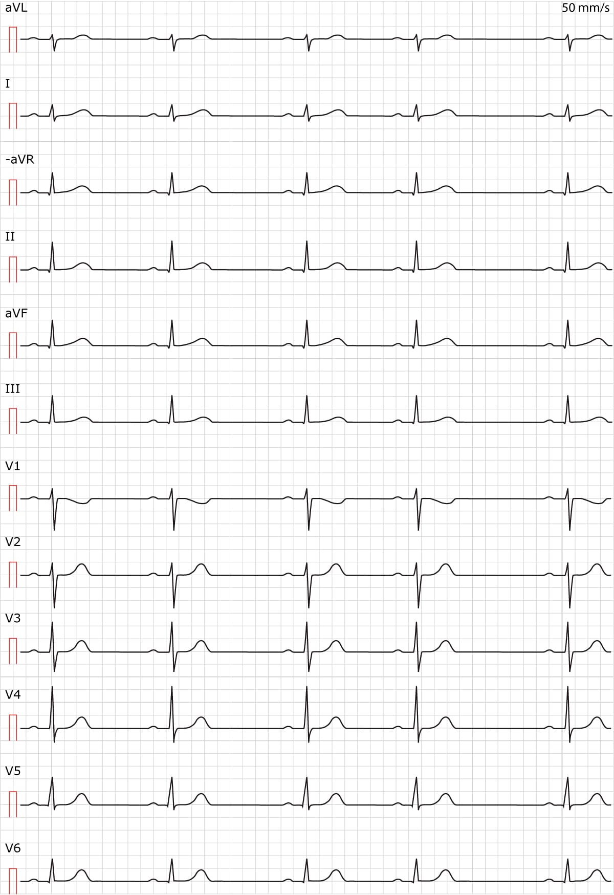 Sinusarrhythmie (Respiratorische Sinusarrhythmie) – Kardiovaskuläre ...