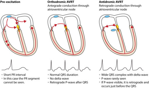 Pre-excitation, Atrioventricular Reentrant (reentry) Tachycardia (AVRT ...