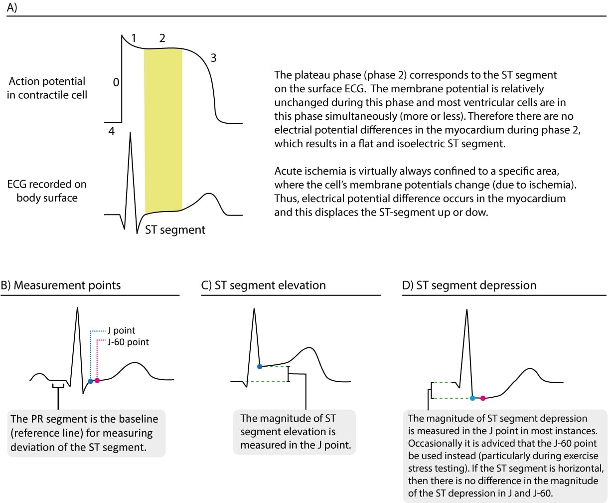 EKG bei Myokardischämie: ischämische Veränderungen von ST-Strecke & T-Welle – EKG & ECHO