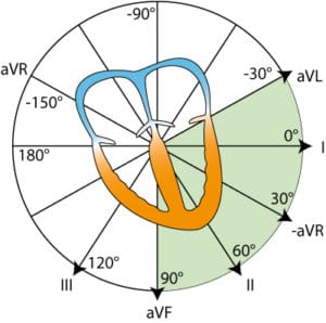 Das Cabrera-Format des 12-Kanal-EKG und Ableitung –aVR anstelle von aVR ...