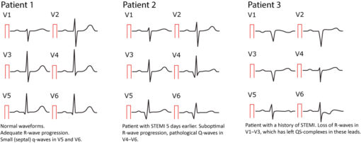 The QRS complex: ECG features of the Q-wave, R-wave, S-wave & duration ...