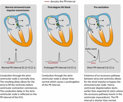 P-wave, PR interval, PR segment: physiology, criteria & ECG findings ...