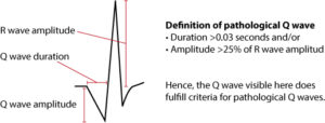 The QRS complex: ECG features of the Q-wave, R-wave, S-wave & duration ...