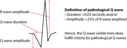 The QRS complex: ECG features of the Q-wave, R-wave, S-wave & duration ...