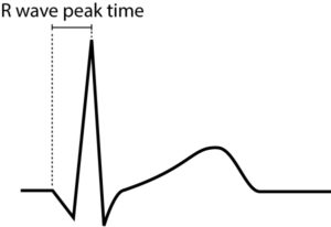 The QRS complex: ECG features of the Q-wave, R-wave, S-wave & duration ...