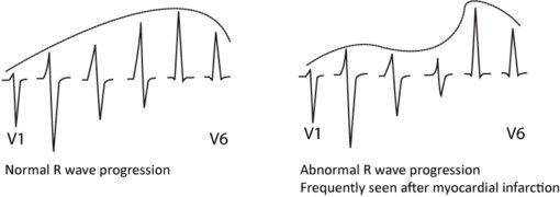 The QRS complex: ECG features of the Q-wave, R-wave, S-wave & duration ...
