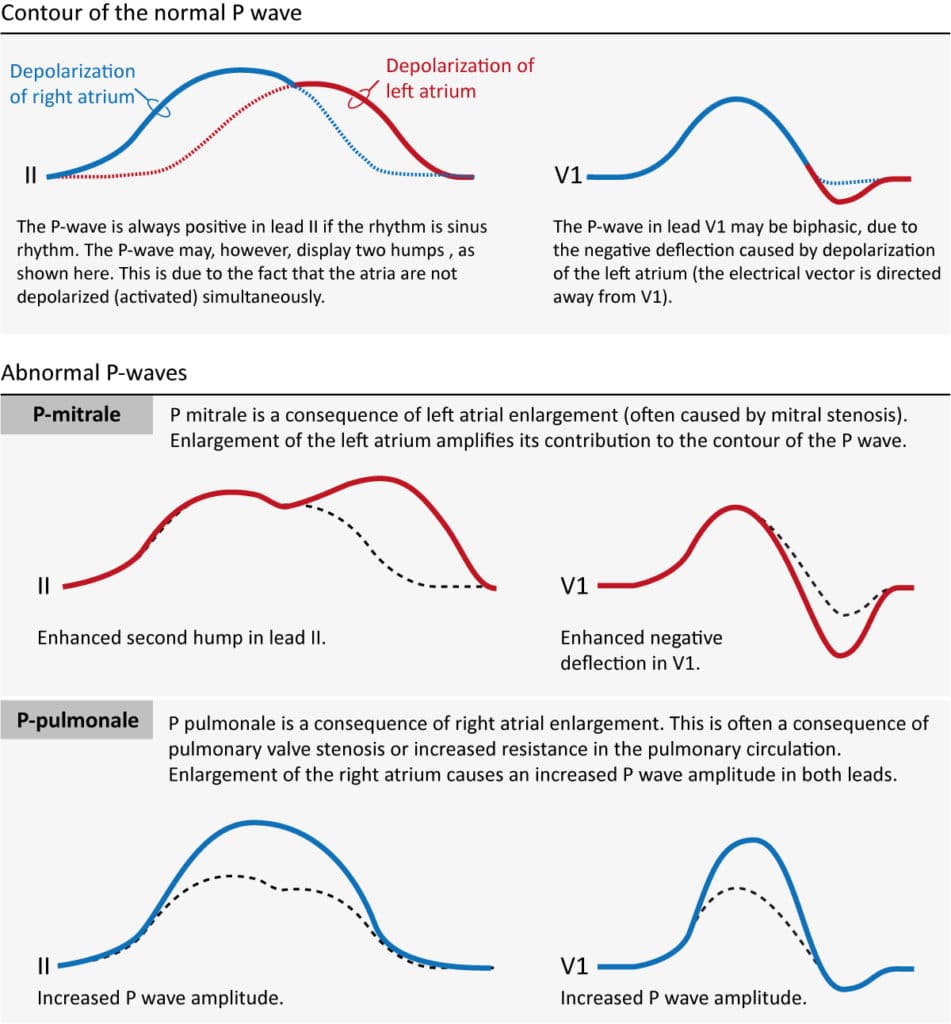P-wave, PR interval, PR segment: physiology, criteria & ECG findings ...