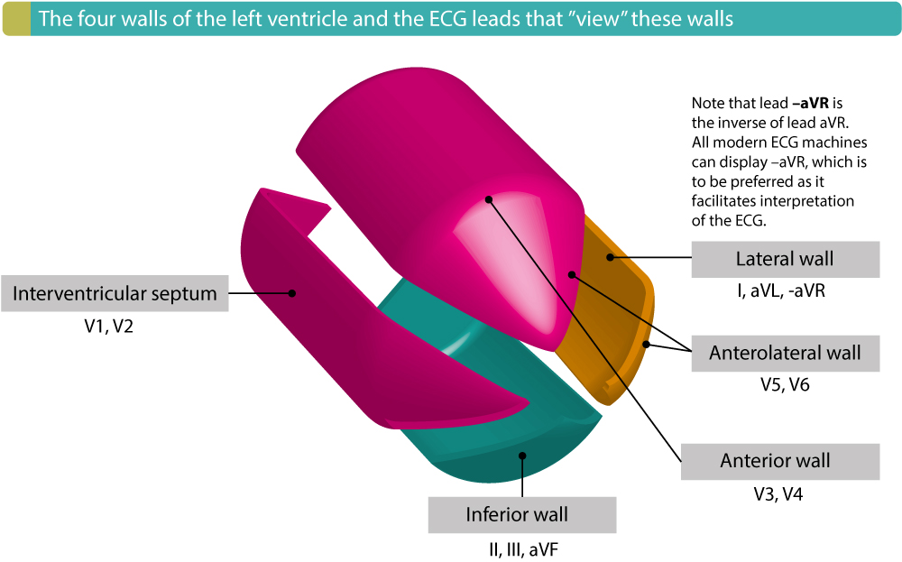 STEMI (ST Elevation Myocardial Infarction): diagnosis, criteria, ECG & management – EKG & ECHO