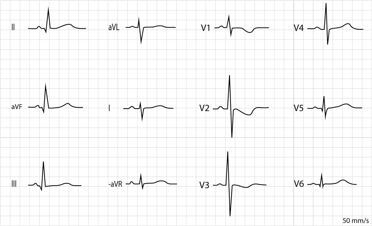 Reference normal Values For Pediatric Neonatal ECG Interpretation Reference normal Values For Pediatric Neonatal ECG Interpretation