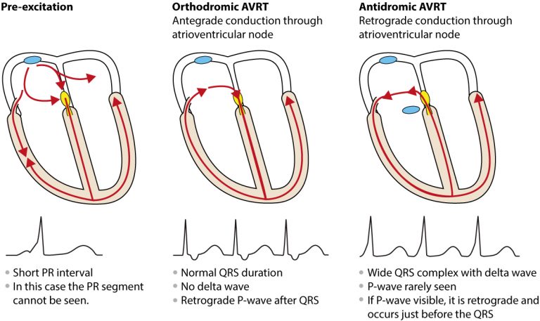 Interpretation of neonatal and pediatric electrocardiograms (ECG) – EKG ...