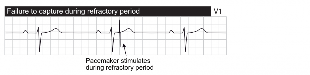 Assessment of Pacemaker Malfunction – EKG & ECHO