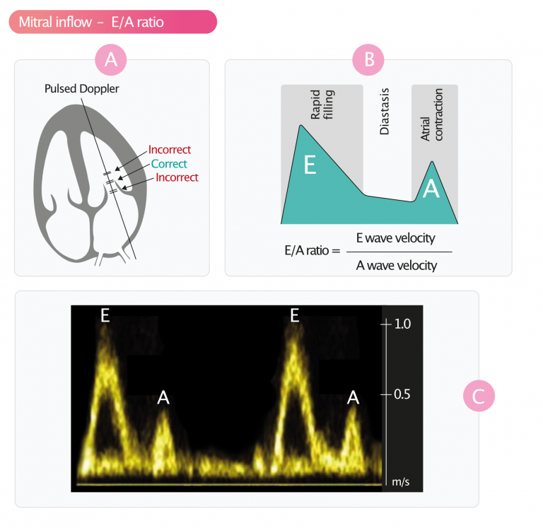Beurteilung der diastolischen Funktion mittels Echokardiographie – EKG ...