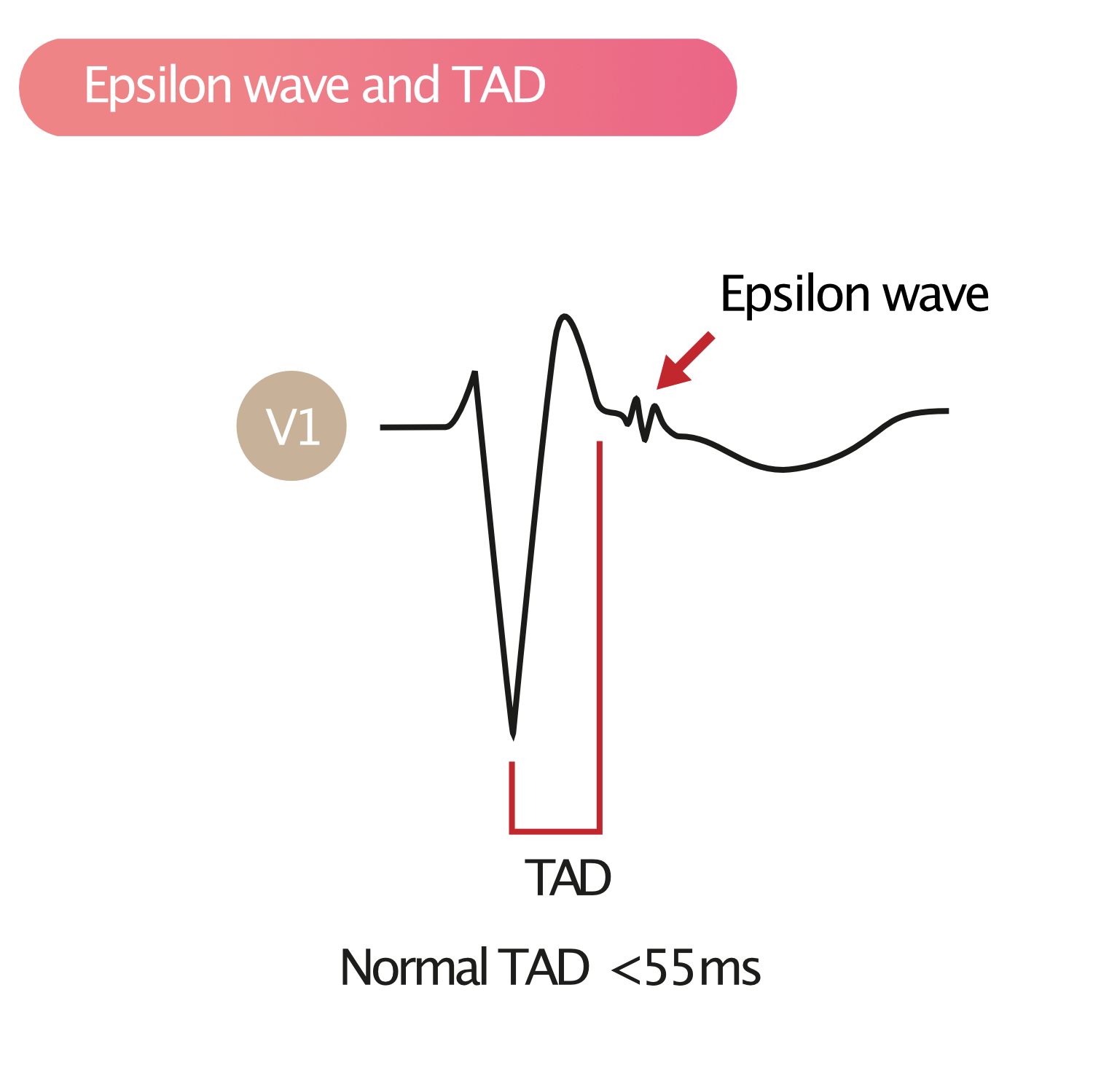 Arrhythmogene rechtsventrikuläre Kardiomyopathie / Dysplasie – EKG & ECHO
