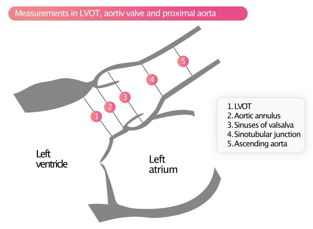 Aortenklappenstenose – EKG & ECHO