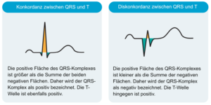 EKG-Interpretation: Merkmale des normalen EKGs (P-Welle, QRS-Komplex ...