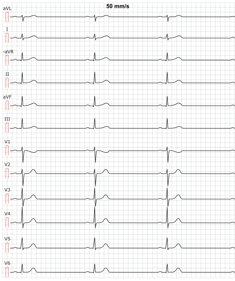 Sinusbradykardie: Definitionen, EKG, Ursachen und Behandlung ...