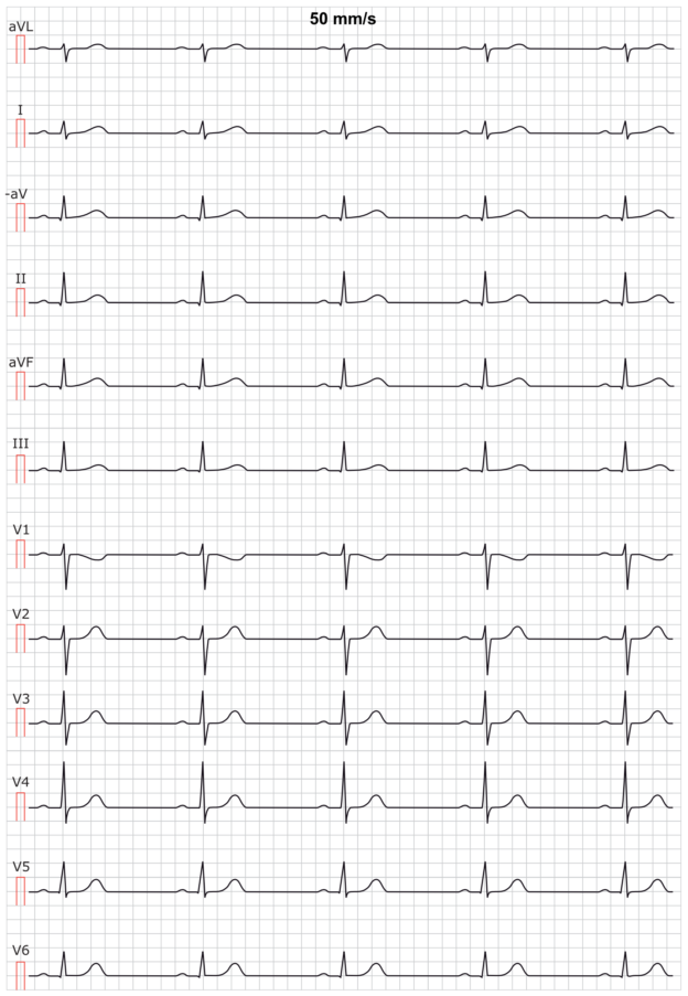 Der Sinusrhythmus: Physiologie, EKG-Kriterien und klinische Bedeutung ...