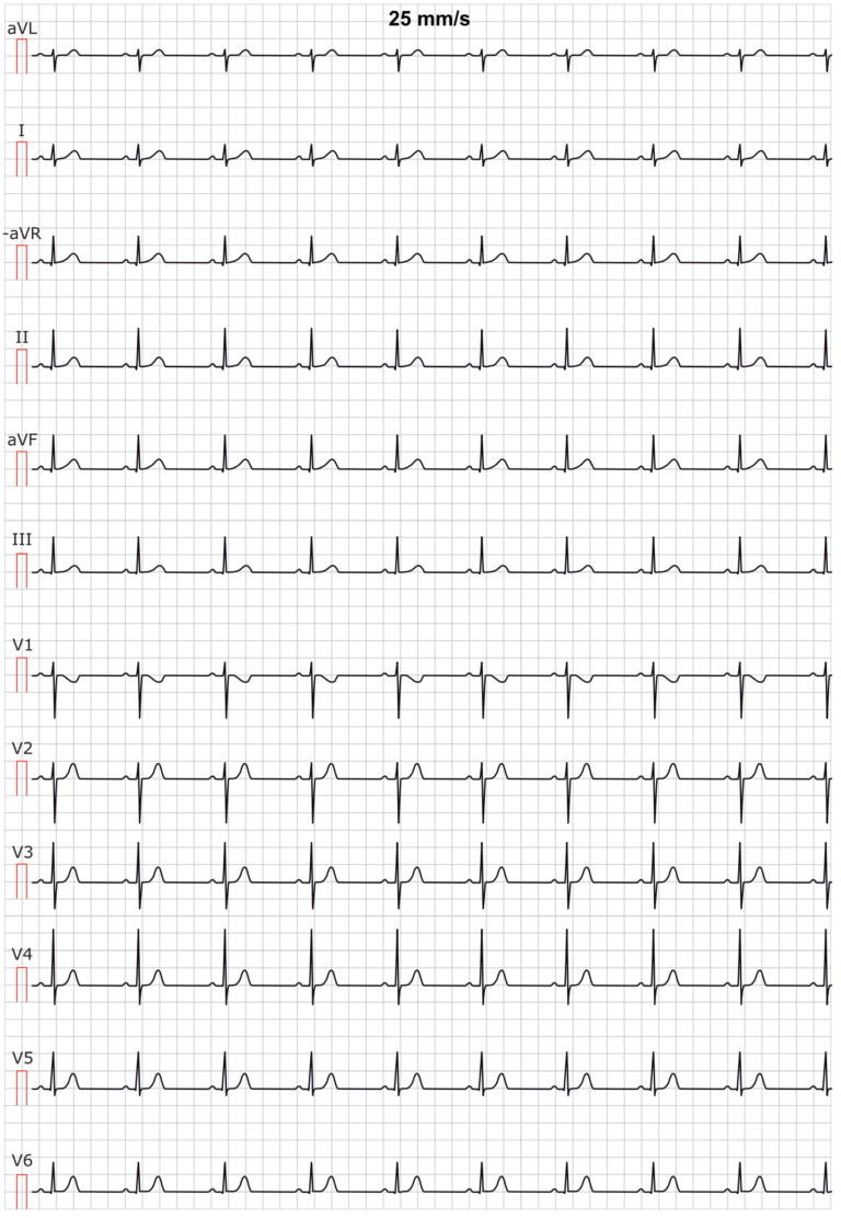 Der Sinusrhythmus: Physiologie, EKG-Kriterien und klinische Bedeutung ...
