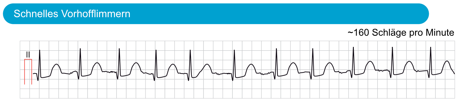 Vorhofflimmern: EKG, Klassifikation, Ursachen, Risikofaktoren ...