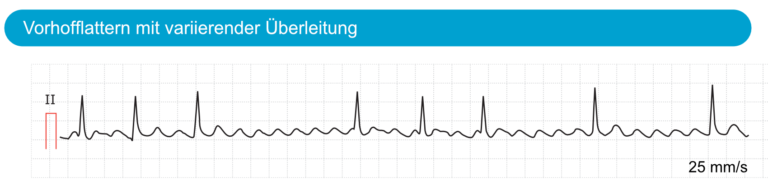 Vorhofflattern: Einstufung, Ursachen, EKG-Kriterien und Management ...