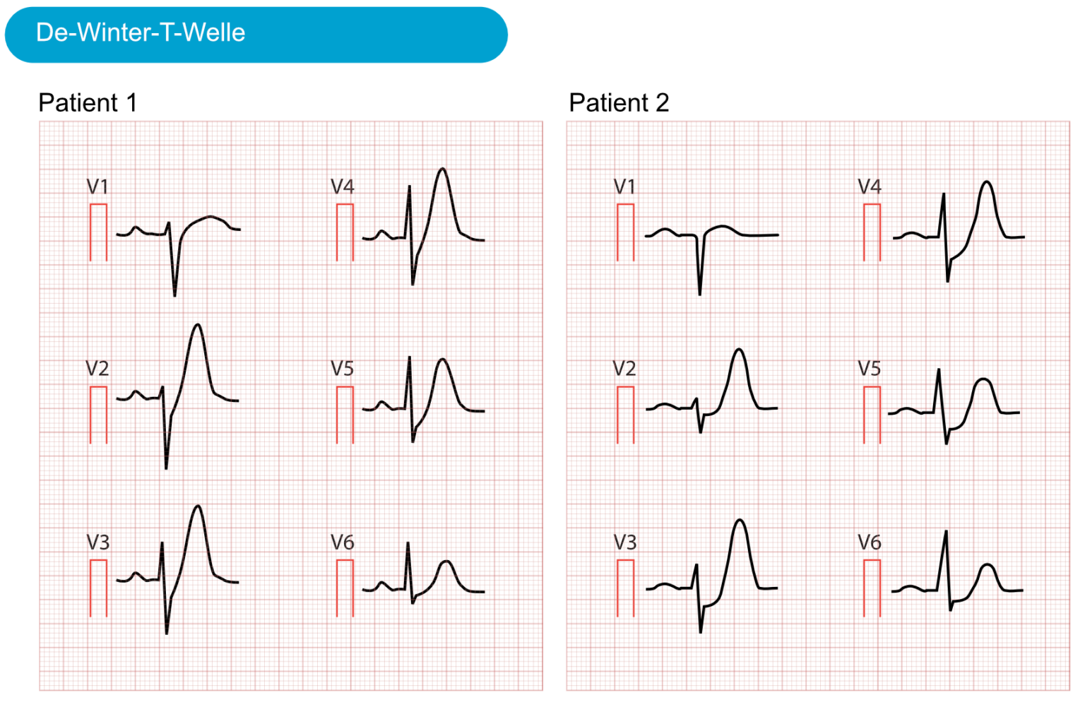 T-Wellen bei Ischämie: hyperakut, invertiert (negativ), Wellens-Syndrom ...