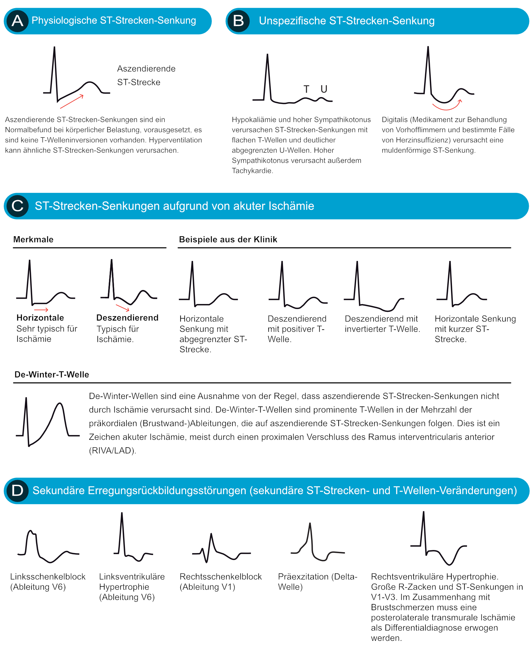ST-Senkung bei Myokardischämie und Differentialdiagnosen – EKG & ECHO