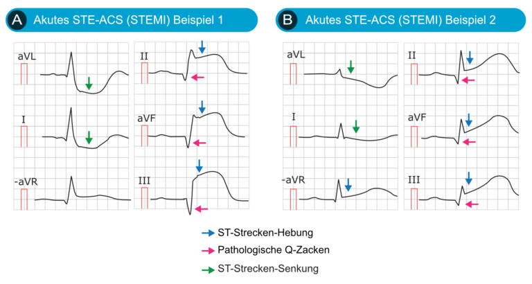 EKG-Zeichen eines Myokardinfarkt: pathologische Q-Zacken ...
