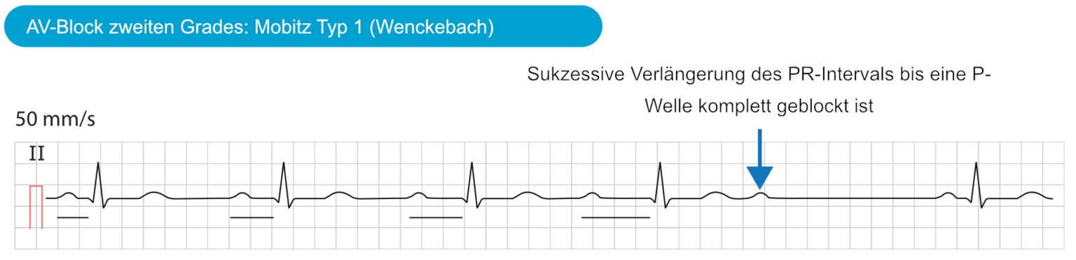 AV-Block zweiten Grades: Mobitz Typ 1 (Wenckebach) & Mobitz Typ 2 ...