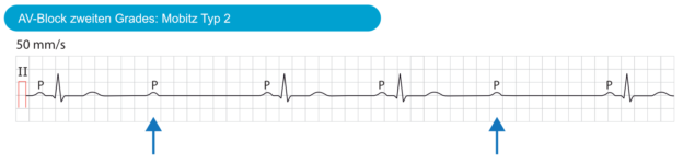 AV-Block zweiten Grades: Mobitz Typ 1 (Wenckebach) & Mobitz Typ 2 ...