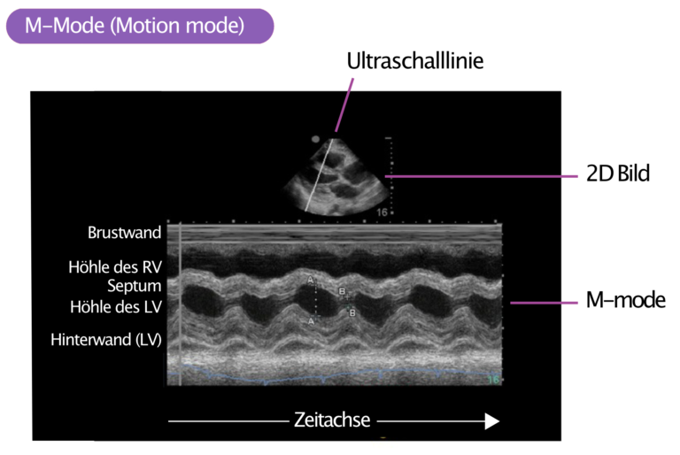 M-Mode Echokardiographie – Kardiovaskuläre Medizin Online