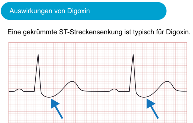 Digoxin (Digitalis) - EKG-Veränderungen, Arrhythmien, Leitungsstörungen ...