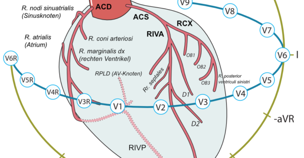 EKG-Zeichen eines Myokardinfarkt: pathologische Q-Zacken ...